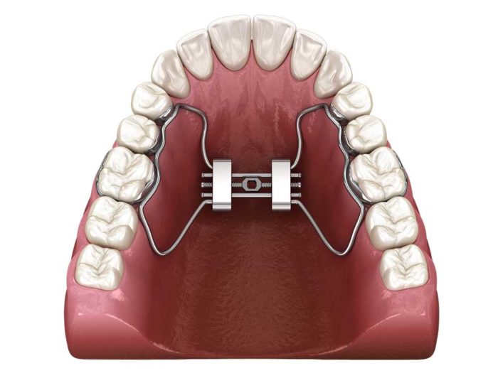 Palatal distraction | Merode Aesthetics — Maxillo-facial surgery